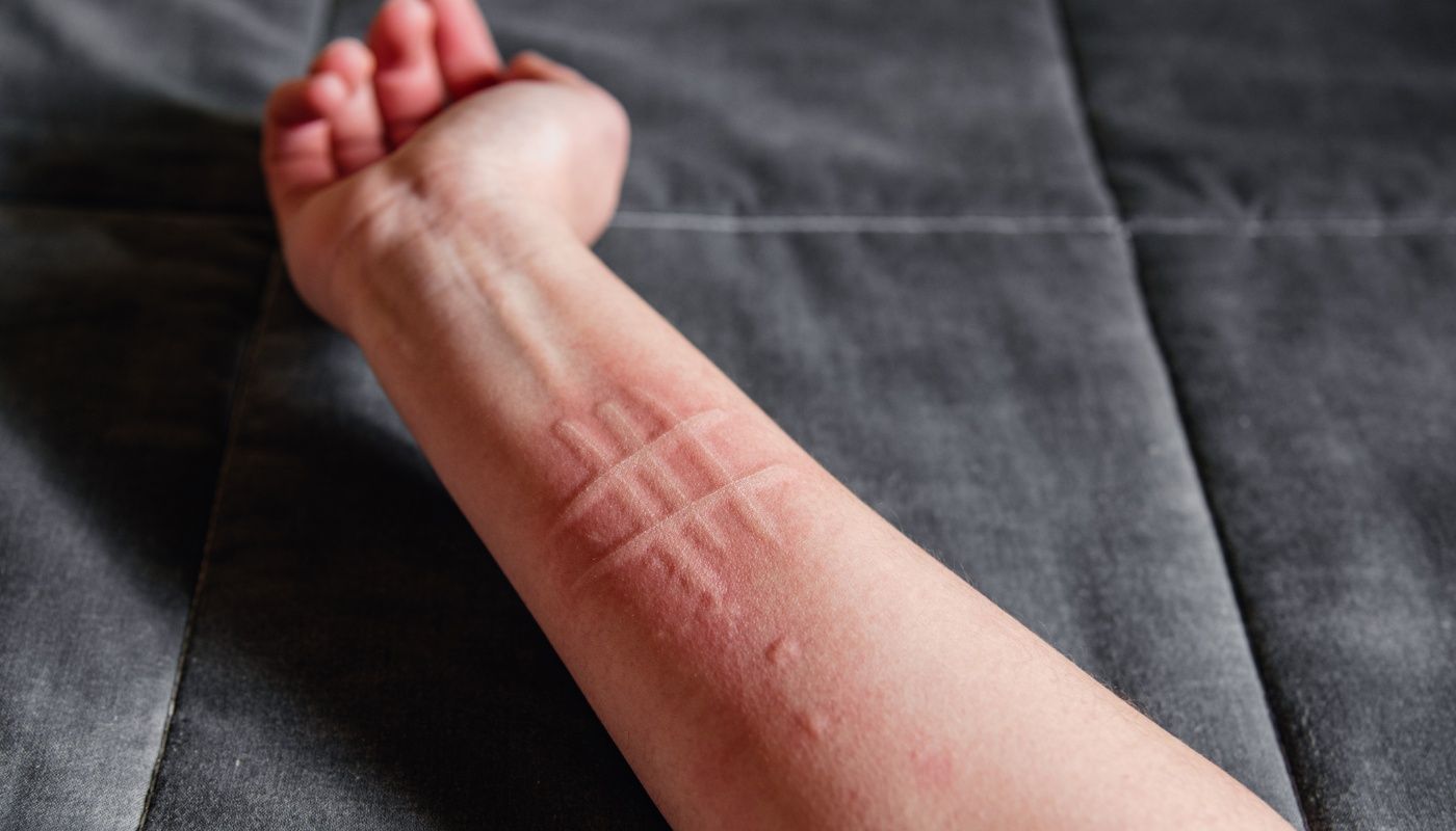Dermographism: Causes, Symptoms, and Natural Remedies