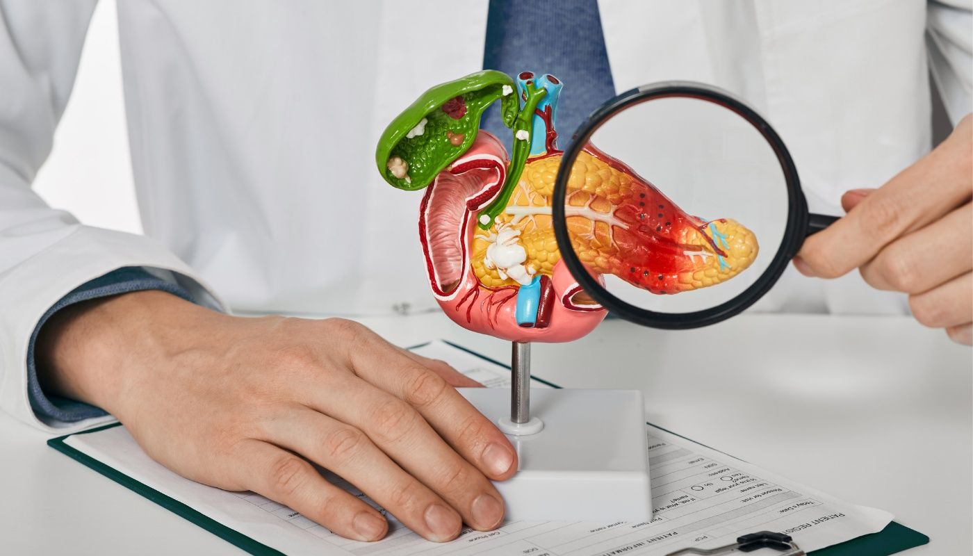 Gallstone Pancreatitis: Symptoms, Treatment, and Prevention